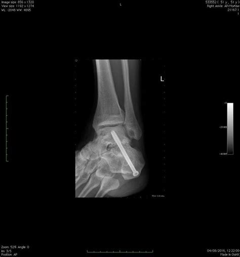 Subtalar Fusion X Ray Subtalar Fusion Firstaid Medical Novelty