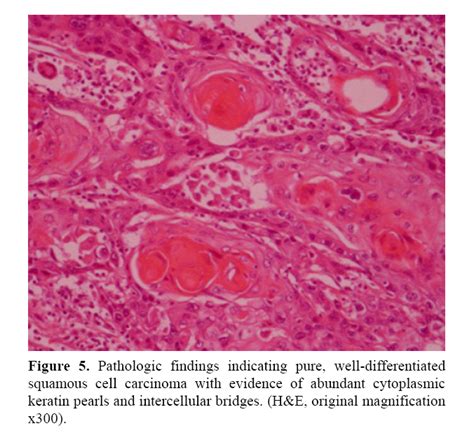Squamous Cell Carcinoma Lung Keratin Pearls