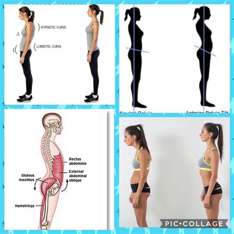 Poor Posture And The Anterior Pelvic Tilt Nagy Orthodontic Academy