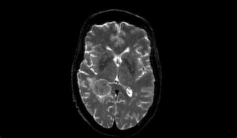Choroid Plexus Papilloma CPP MRI Radiology Article On Choroid Plexus Papilloma