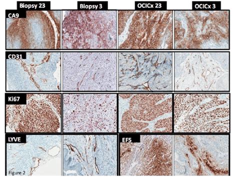 Hypoxia Blood Vessel And Proliferation Staining Ihc Staining In The