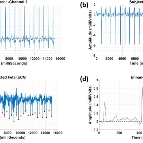 An Example Of Clinical Fetal Ecg Separation And Enhancement A Download Scientific Diagram
