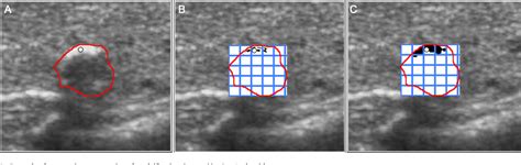 Figure 1 From Computerized Analysis Of Calcification Of Thyroid Nodules