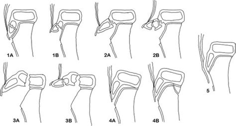 Tibial Tubercle Fracture Flashcards Quizlet