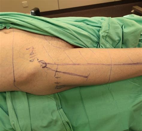 International Journal Of Case Reports And Clinical Images