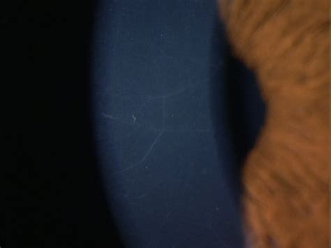 H18 59 Posterior Polymorphous Dystrophy Decision Maker Plus