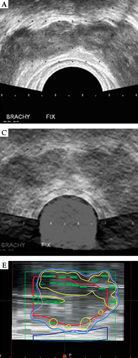 Table 1 From Dosimetry Of Permanent Interstitial Prostate Brachytherapy