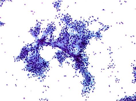 Pathology Outlines Leydig Cell