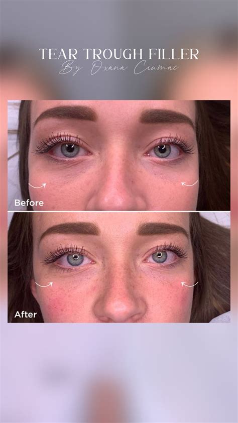 Artfaceclinic Tear Trough Dermal Fillers Tear Trough Fillers