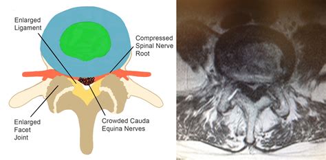 Spinal Stenosis Spines Dorset