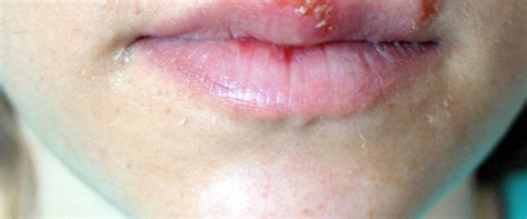 Exploring The Risks Of Recurrent Outbreaks And Long Term Complications