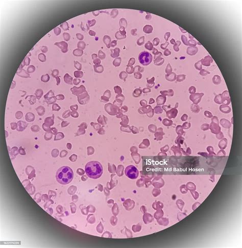 Photomicrograph Of Hematological Slide Showing Rbc Wbc And Platelet