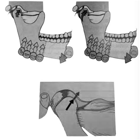 Occlusal Splint Flashcards Quizlet Occlusal Splint Flashcards Quizlet