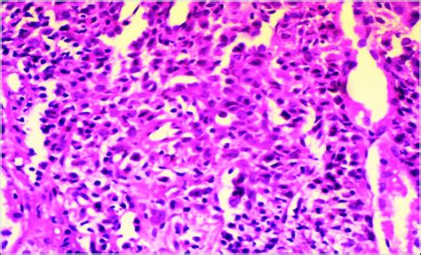 Final Histological Section Of The Gastrectomy Specimen Showing Single Download Scientific