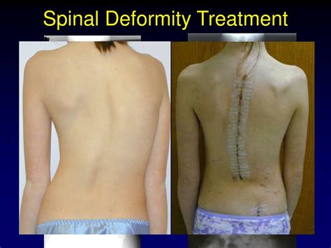 Ppt Spinal Deformity And Degeneration Powerpoint Presentation Free