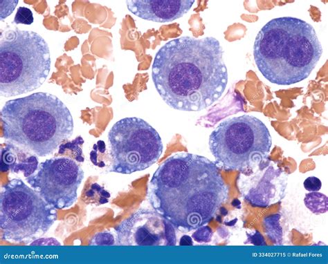 Reactive Mesothelial Cells Pleural Fluid