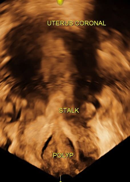 Endometrial Polyp With A Stalk Presenting In The Cervix Looking