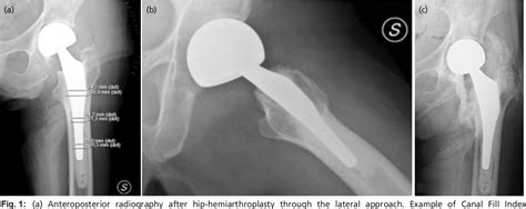 Figure 1 From Comparison Of Anterior And Lateral Approach In Hip