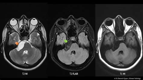 Ultimate Radiology Epidermoid Cyst Of The Cerebello Pontine Angle Cpa