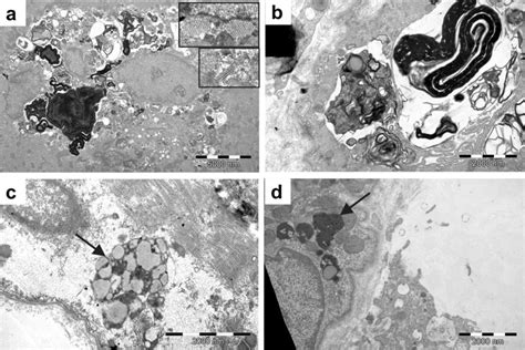Localization Of Inclusion Bodies In The Sarcoplasm The Ultrastructure