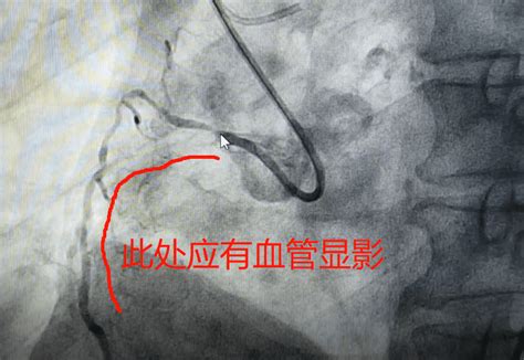 冠脉钙化加慢闭石头反倒成了开通血管的路标 廖教授