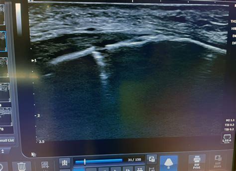 Admir Hadzic On Linkedin Pocus Ultrasound Msk Nysora