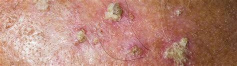 Actinic Keratosis Belmar Dermatology And Cosmetics
