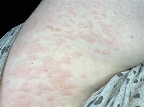 Allergic Reactionhives Rhives