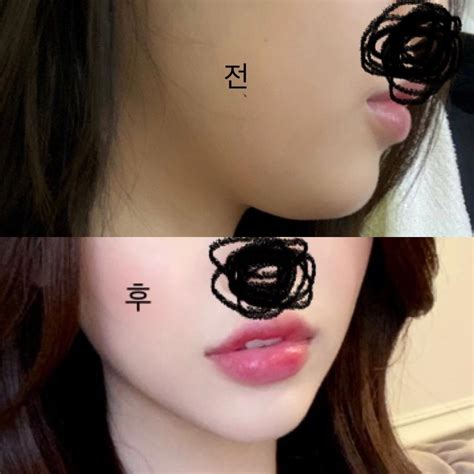 자유수다 윤곽주사 울쎄라 후 강남언니 1등 성형수술and피부시술 정보앱
