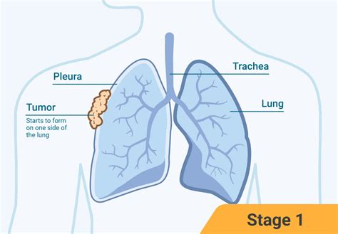 Pleural Mesothelioma Stages Mesothelioma Guide