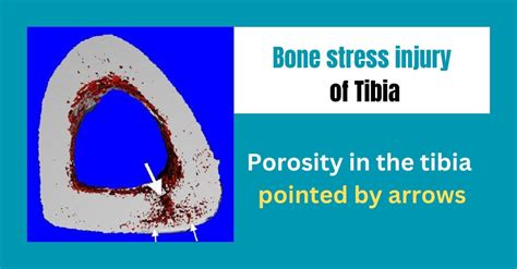 Difference Between Medial Tibial Stress Syndrome And Stress Fracture