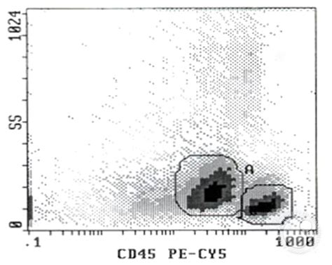 Precursor T Lymphoblastic Leukemialymphoma 3