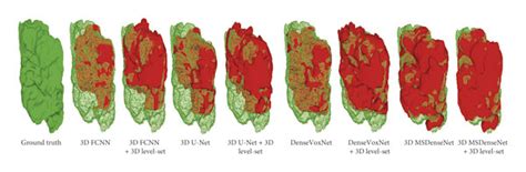 Qualitative Comparison Of Colorectal Tumor Segmentation Results