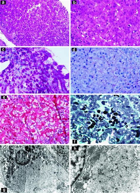 Hepatitis B Ground Glass Hepatocytes