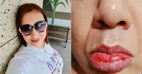 Mulher Que Ficou Com Boca Inchada Por Uso De Creme Dental Irá Processar Fabricante Angústia