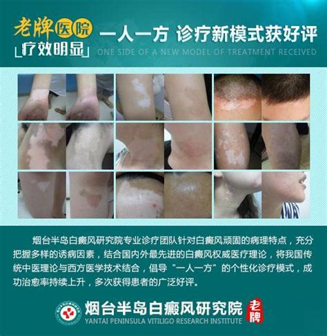 被白癜風「纏上身」，男性同胞們雄風何在？ 每日頭條