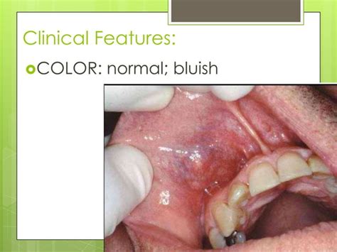 Canalicular Adenoma Ppt