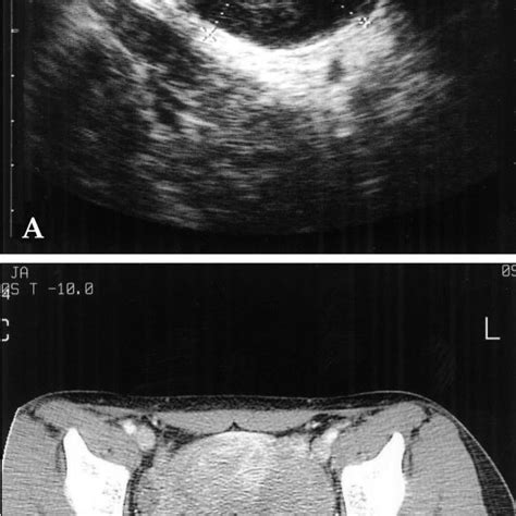 Pdf Ovarian Thecoma With Virilizing Manifestations