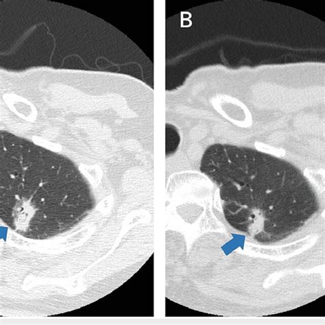 Chest Computed Tomography Computed Tomography Obtained A Before And