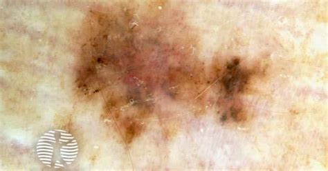 Dermoscopy Multicomponent Pattern Melanoma Image