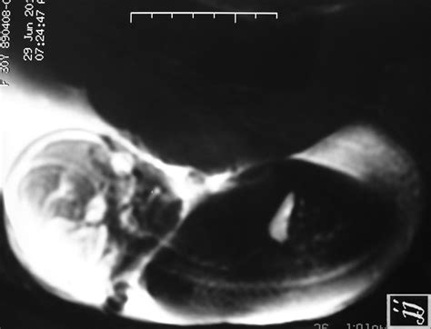 Mri Of Fetus Radiopaedia