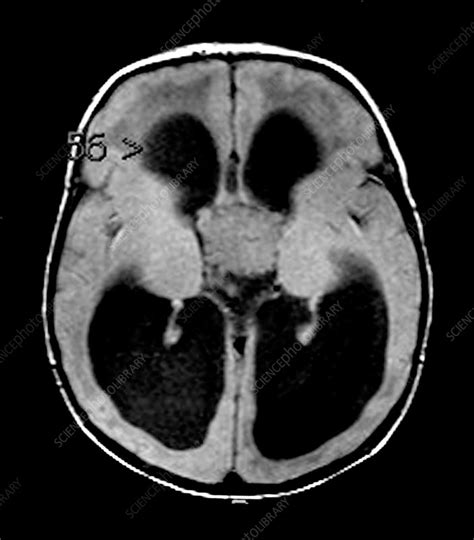 Mri Choroid Plexus Papilloma In Infant Stock Image C043 3063