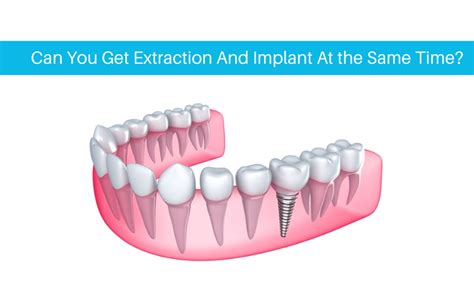 Can You Get Extraction And Implant At The Same Time