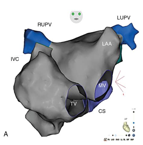 Electroanatomic Mapping And Magnetic Guidance Systems Thoracic Key