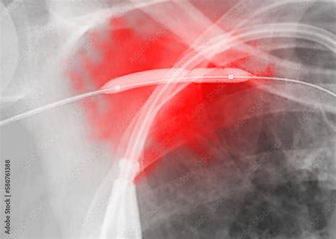Image Of Angioplasty Balloon Angioplasty And Percutaneous Transluminal