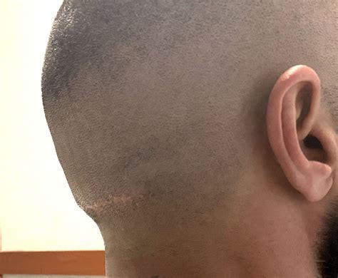 Male Secondary Occipital Scalp Roll Side Vew 1 Dr Barry Eppley