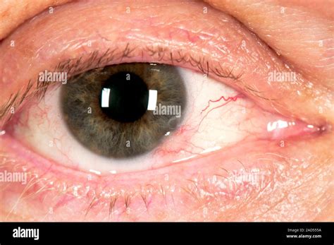 Phlyctenule In The Eye Of A 58 Year Old Male Patient A Phlyctenule Or