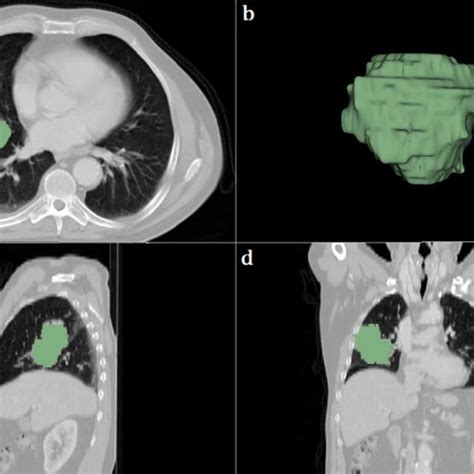 Semi Automatically Segmented Tumour Green Using 3d Slicer Axial
