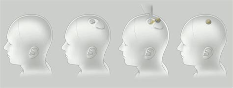 How Neuralink Works All The Things To Know About Elon Musks Bmi Chip