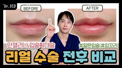 Eng전후사진 안젤리나 입술확대술 리얼 수술 전후 비교💋 Youtube